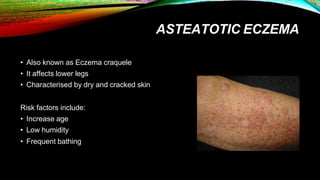 eczema complete information including treatment | PPTX