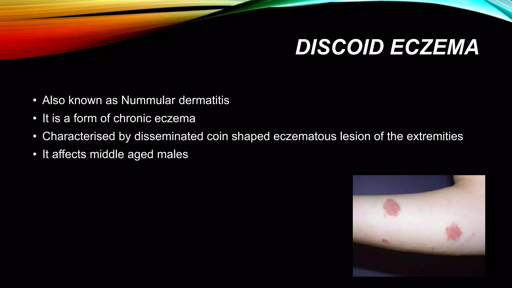 Eczema or Dermatitis | PPTX