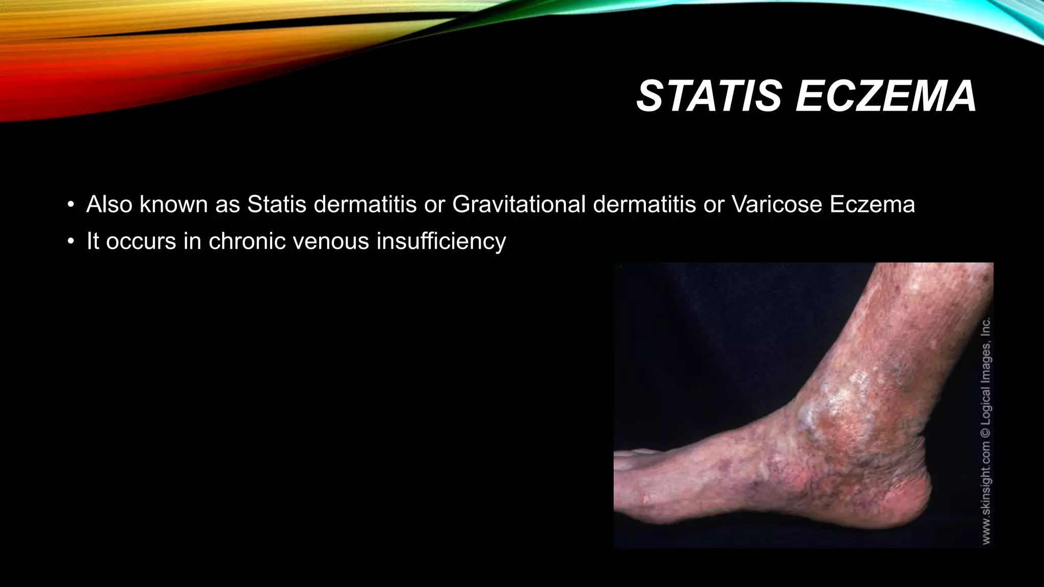 Eczema or Dermatitis | PPTX
