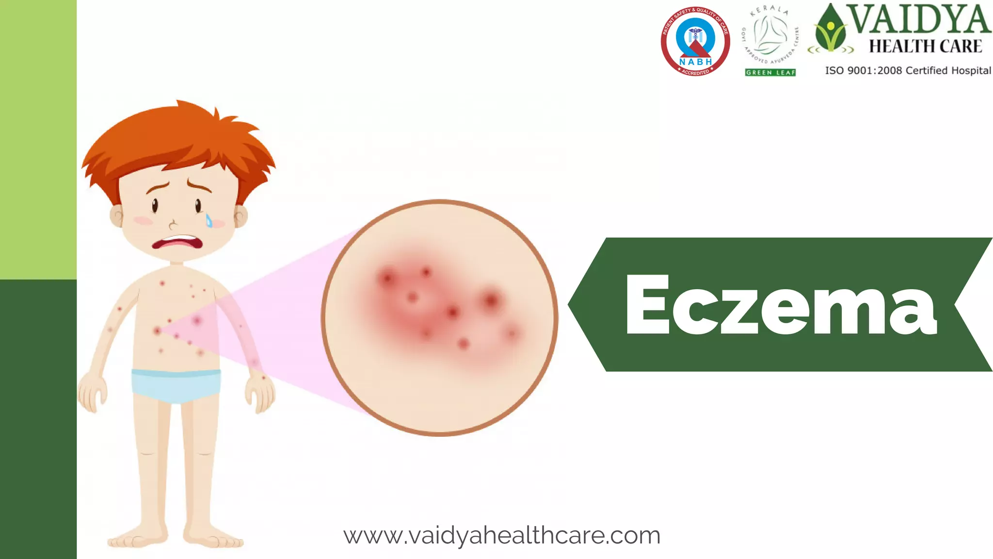 Eczema | PPT