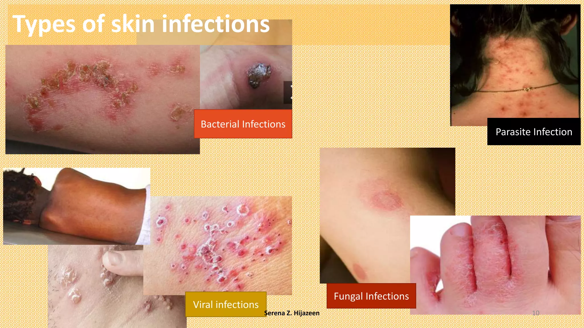 Eczema (Atopic Dermatitis) Definition, clinical presentation, and ...
