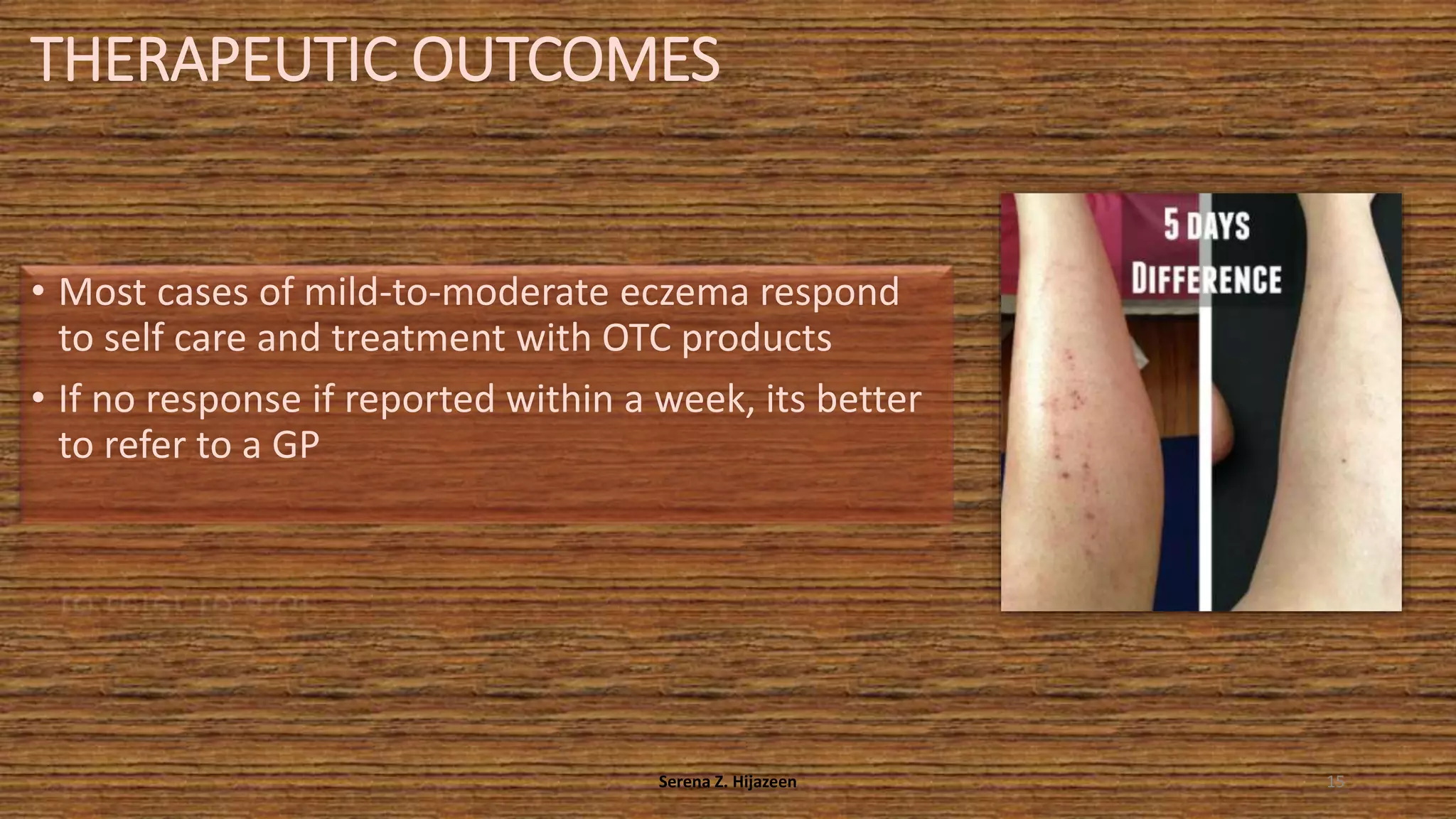 Eczema (Atopic Dermatitis) Definition, clinical presentation, and ...