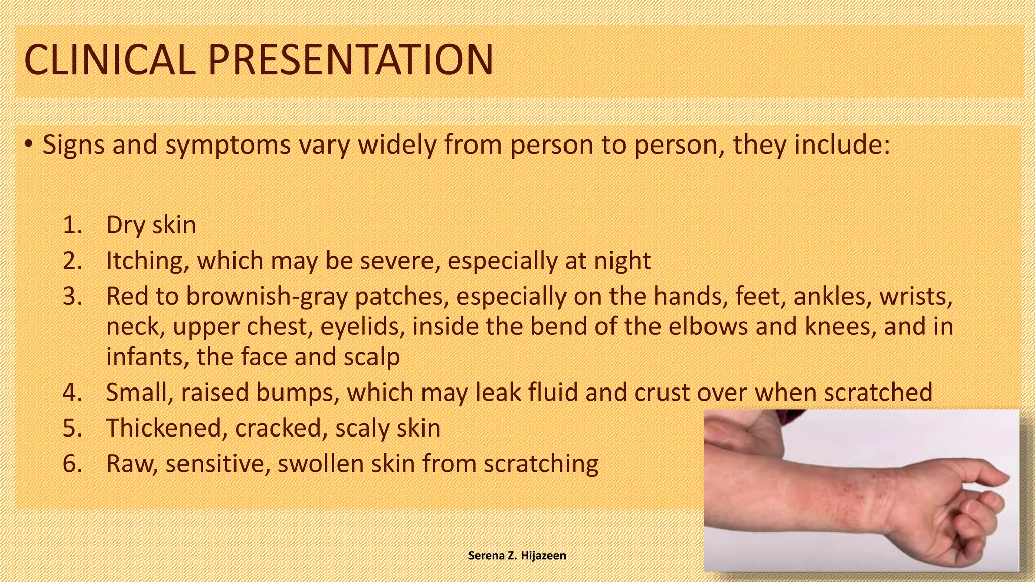 Eczema Atopic Dermatitis Definition Clinical Presentation And Management Ppt