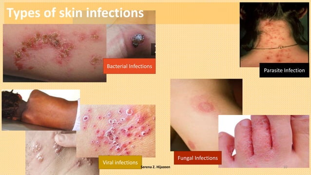 Eczema (Atopic Dermatitis) Definition, clinical presentation, and ...