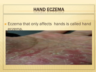 Eczema | PDF