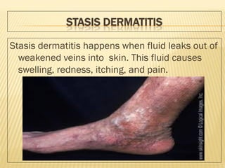 Eczema | PDF