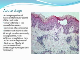 Eczema | PPTX