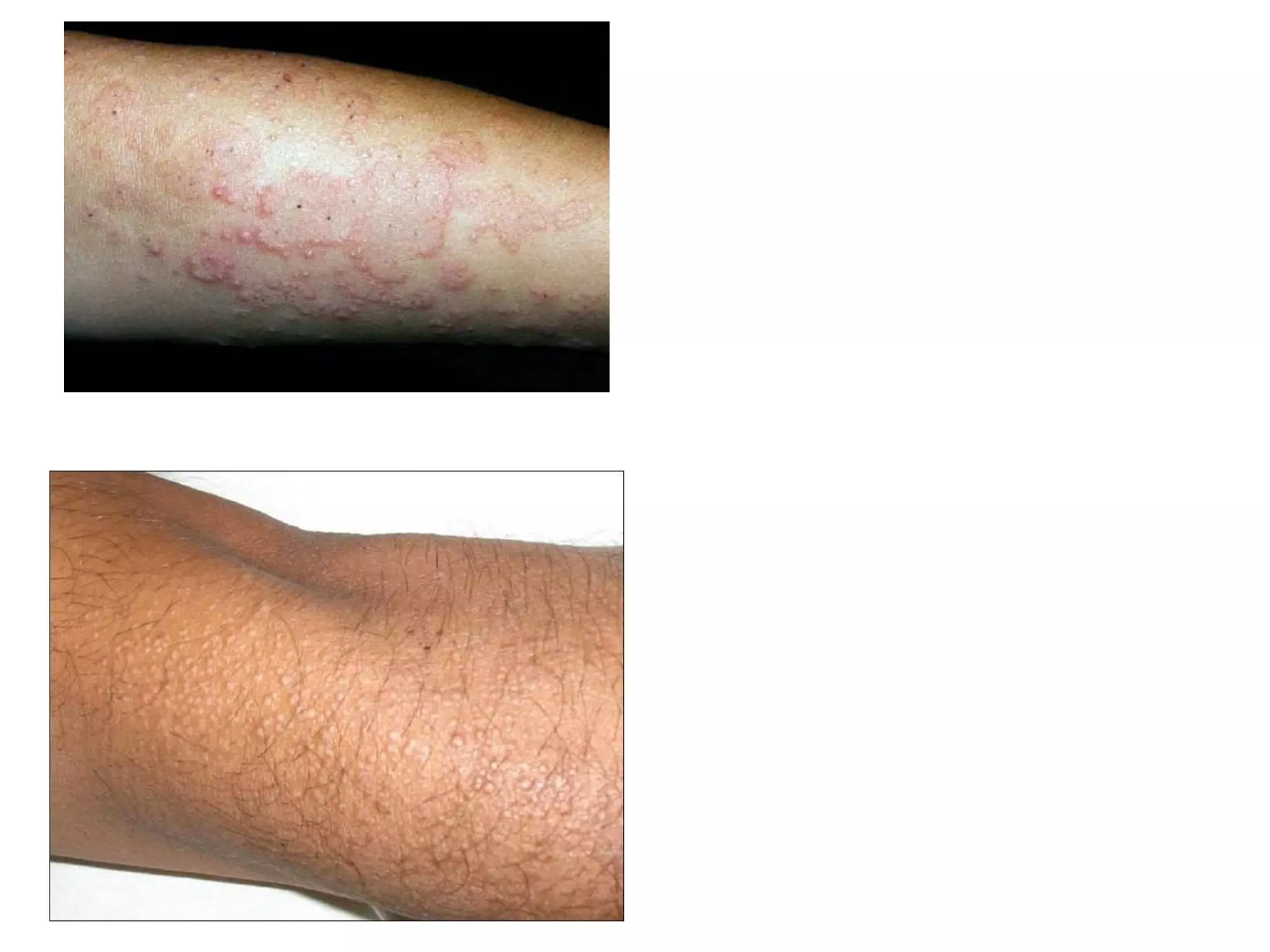 eczema.pptx