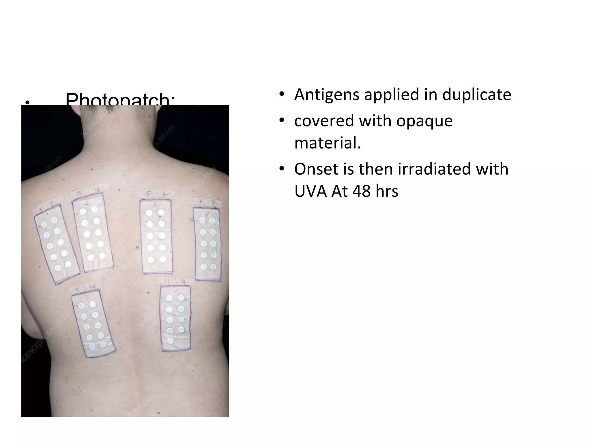 eczema.pptx