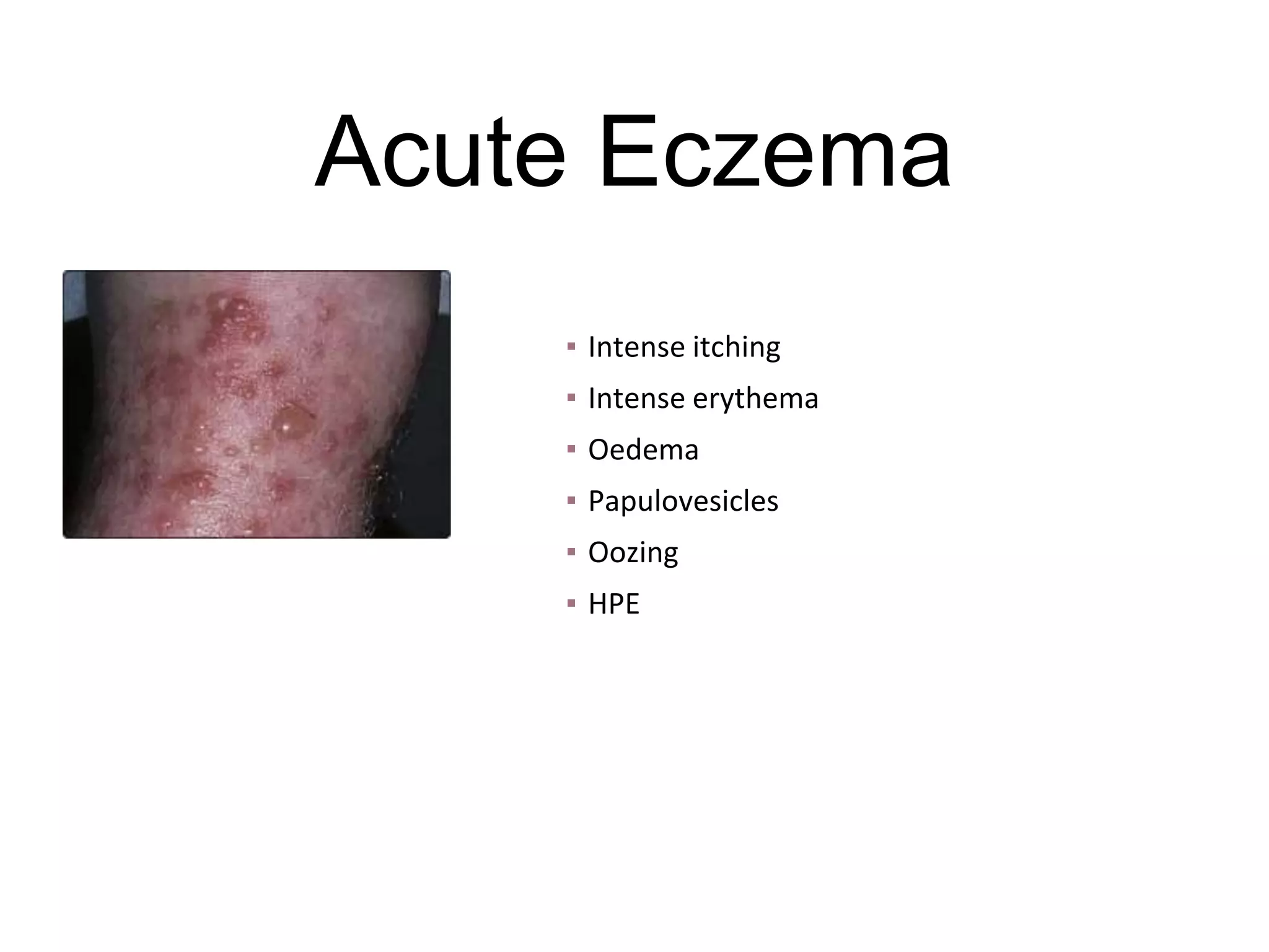 eczema.pptx | Allergies | Diseases and Conditions
