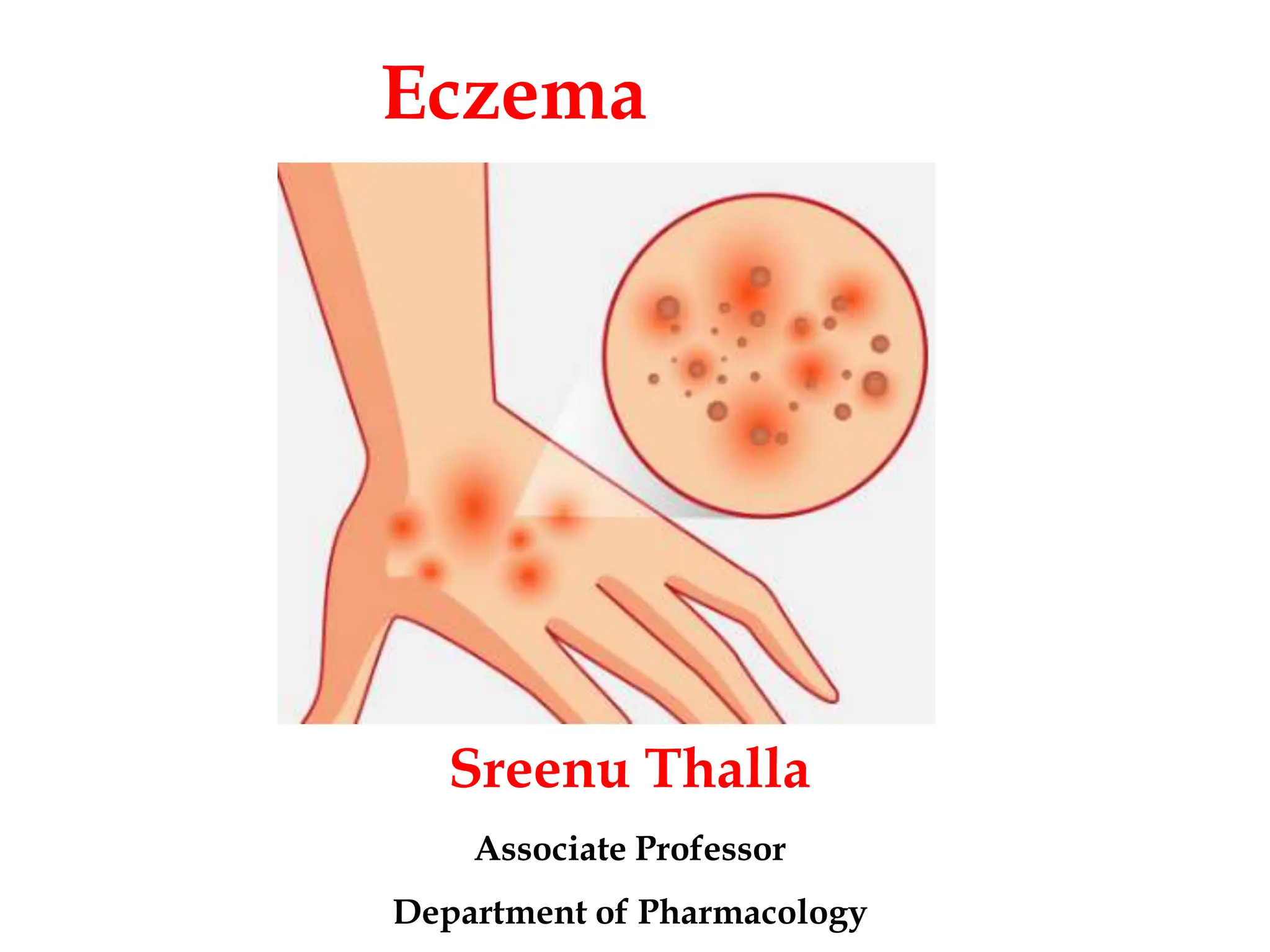 Clinical Pharmacotherapy of Eczema disease.pptx
