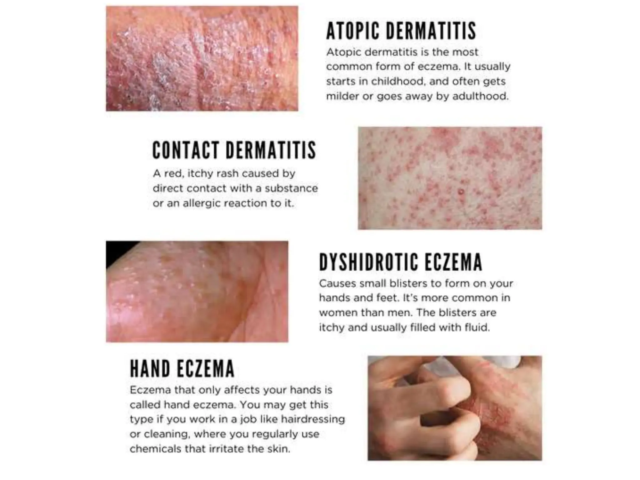 Clinical Pharmacotherapy of Eczema disease.pptx