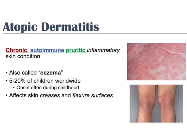 Clinical Pharmacotherapy of Eczema disease.pptx