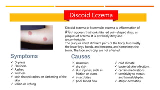 ECZEMA. . | PPTX