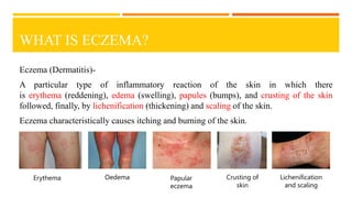 ECZEMA. . | PPTX