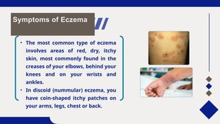 Overview about Eczema and Treatment.pptx
