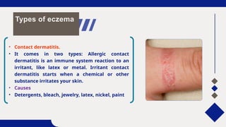 Overview about Eczema and Treatment.pptx