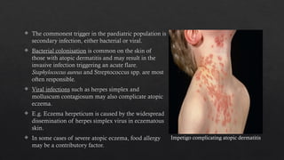 skin disease Eczema pharmacotherapeutics | PPTX