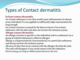 Eczema basic principles | PPTX