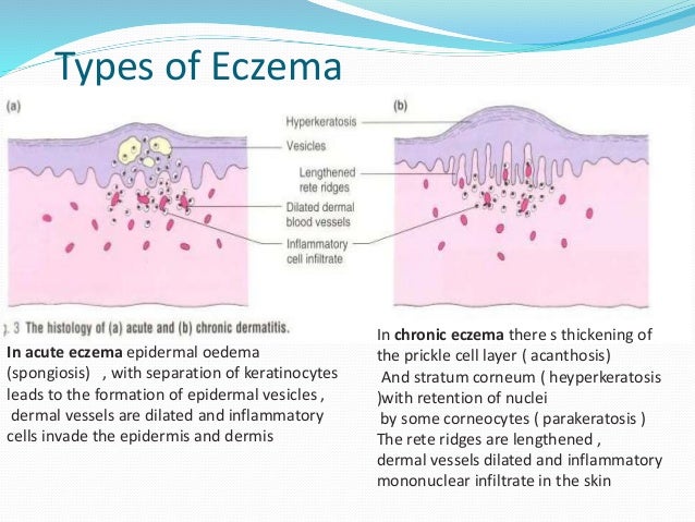 Eczema basic principles