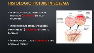 Eczema by sanaullah | PPTX