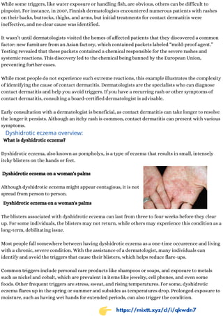 eczema. eczema treatment .eczema for kids | PDF