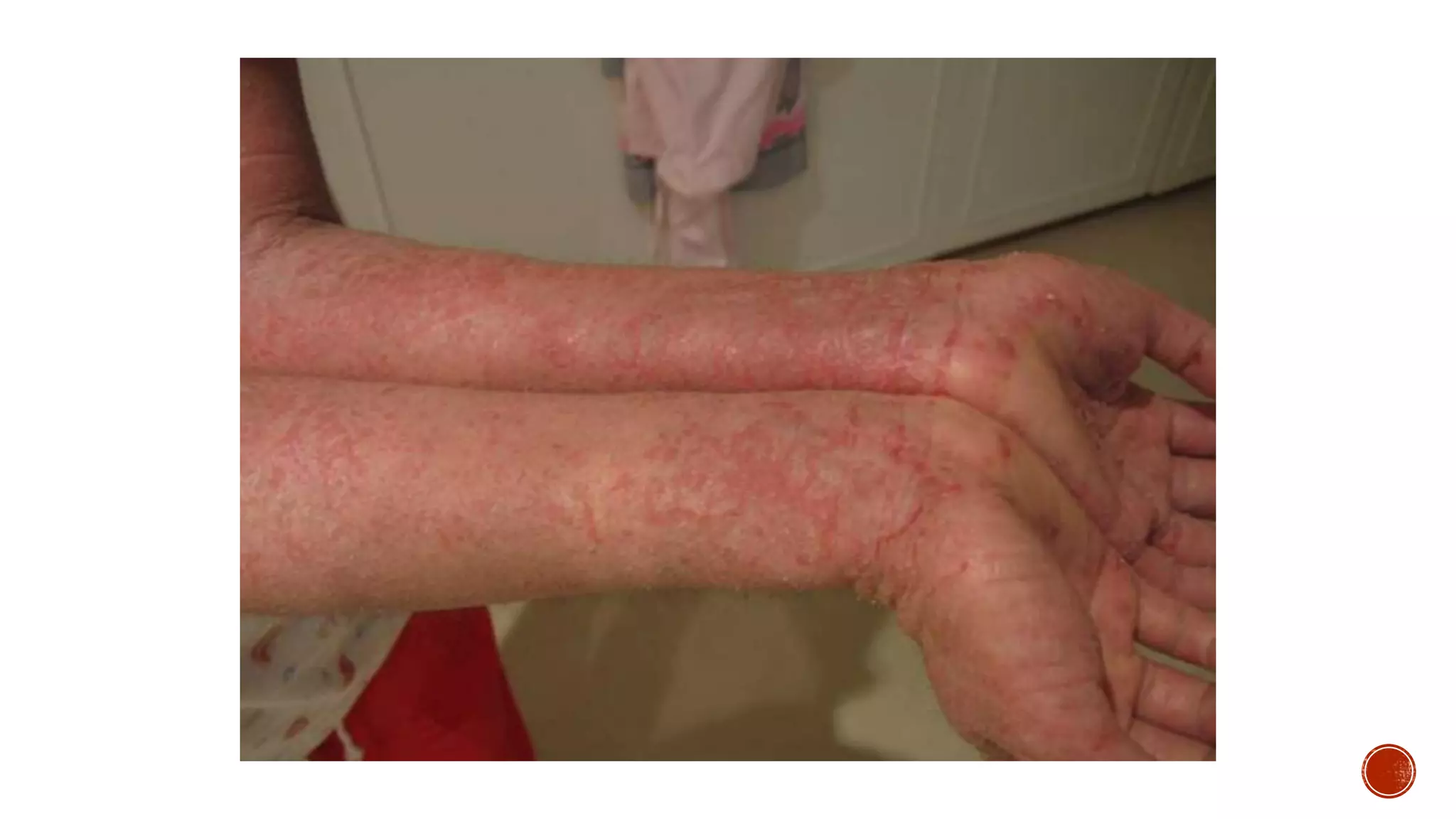 Eczema (The Itch that rashes) | PPT
