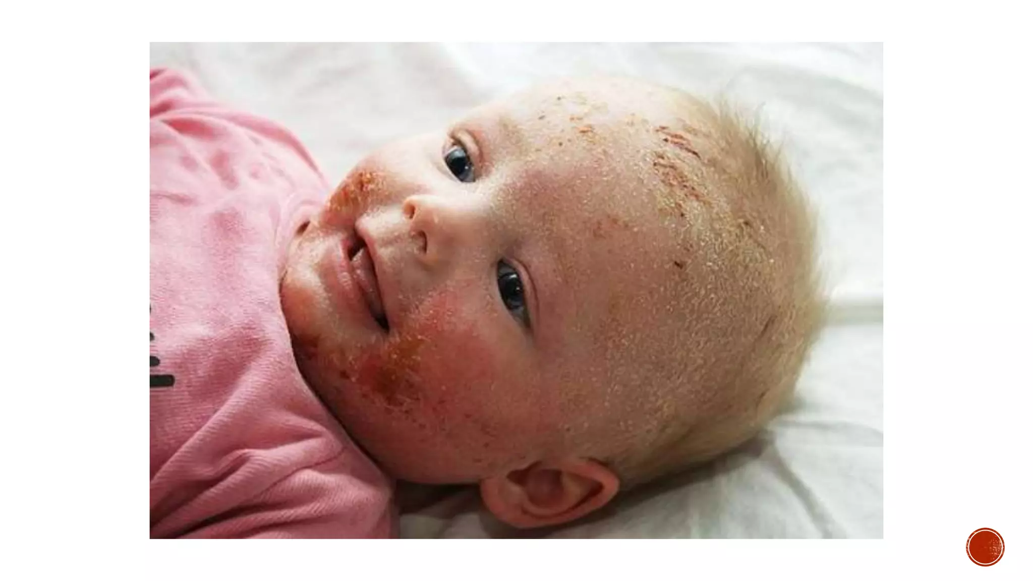 Eczema (The Itch that rashes) | PPT