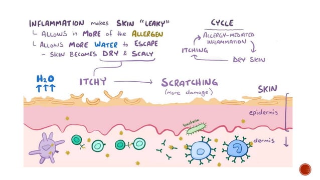 Eczema (The Itch that rashes) | PPT