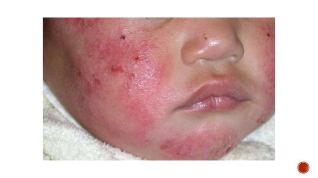 Eczema (The Itch that rashes) | PPT