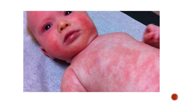 Eczema (The Itch that rashes) | PPT