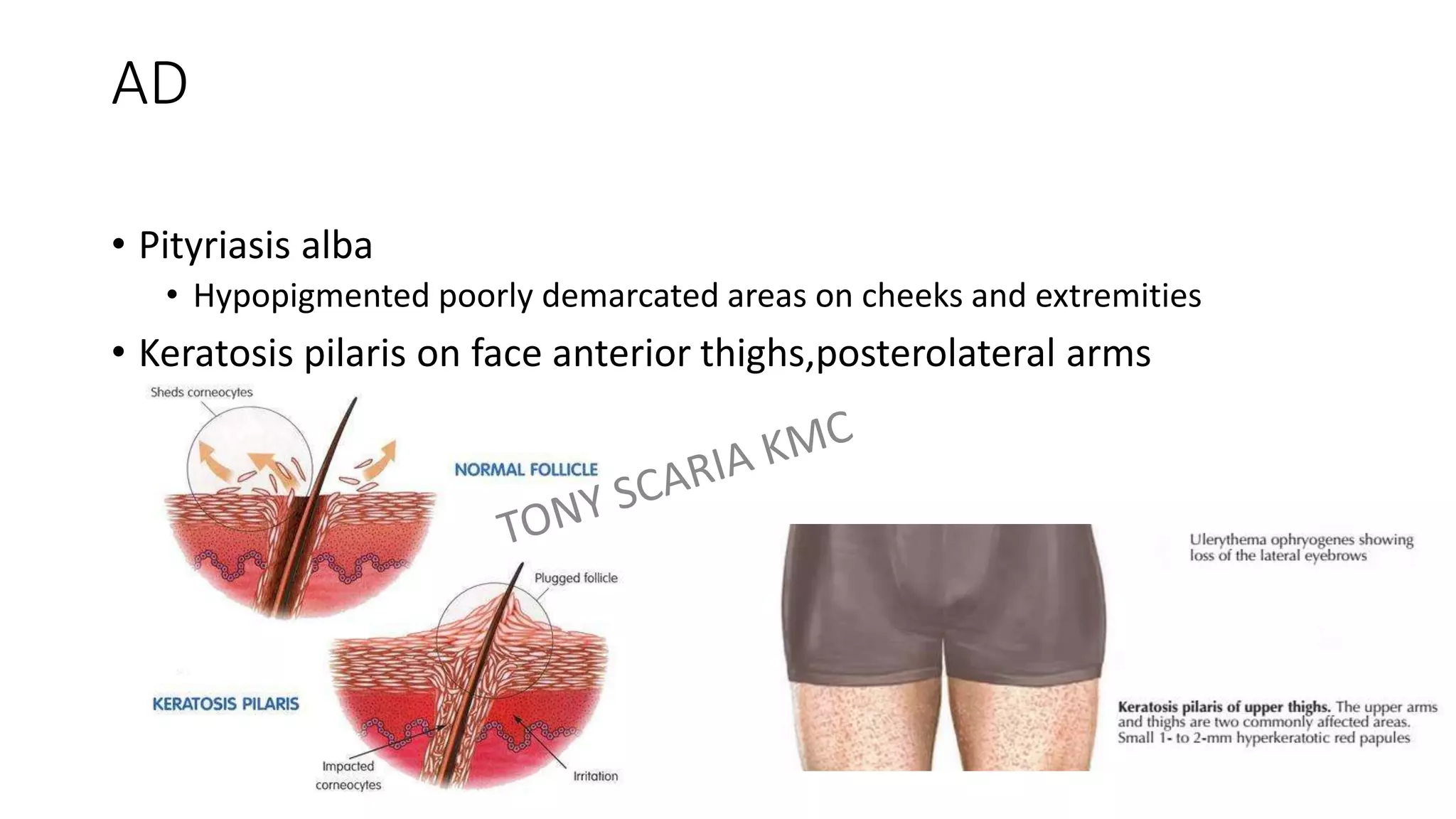 Eczema and dermatitis DERMATOLOGY | PDF