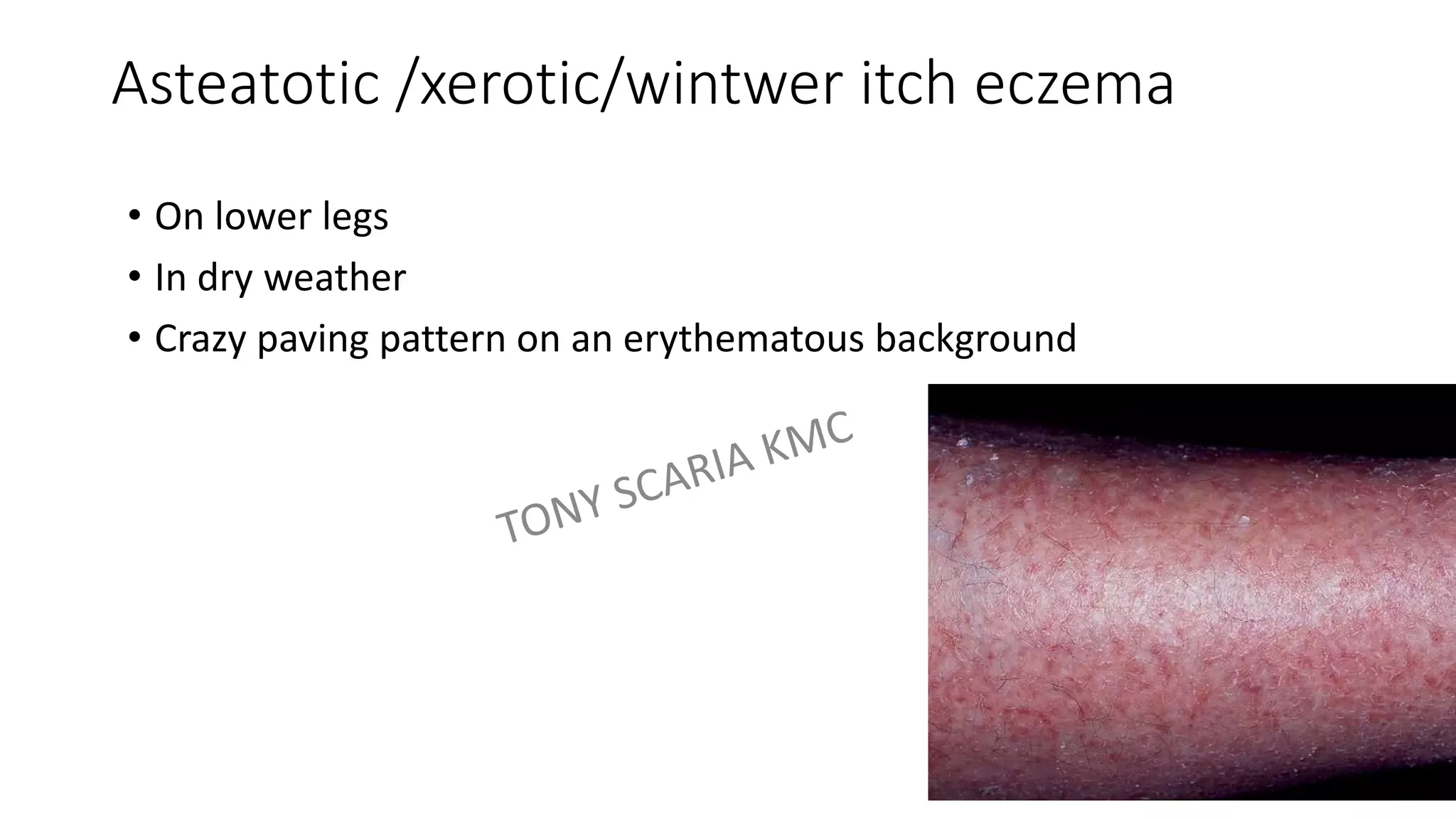 Eczema and dermatitis DERMATOLOGY | PDF