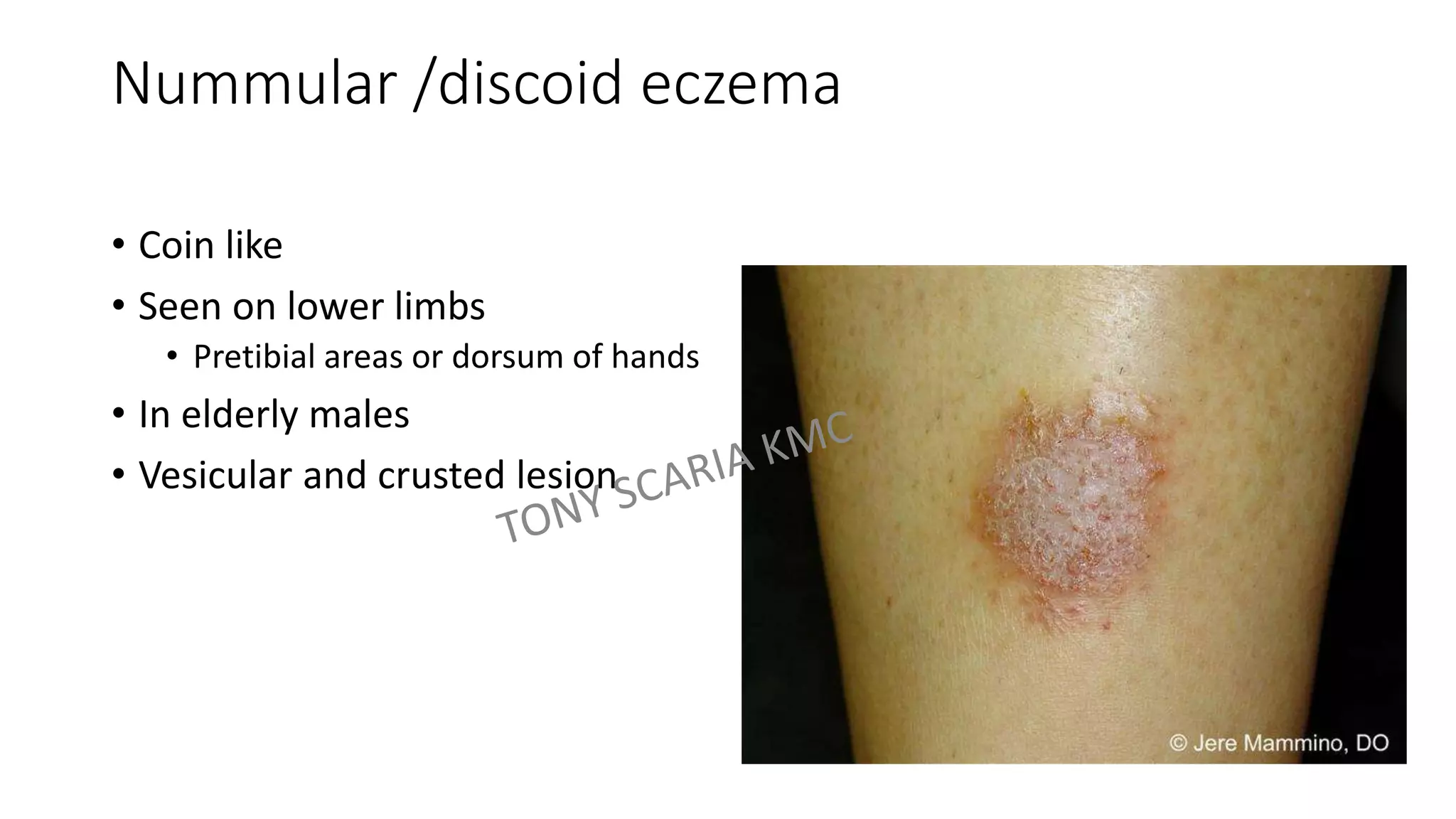 Eczema and dermatitis DERMATOLOGY | PDF