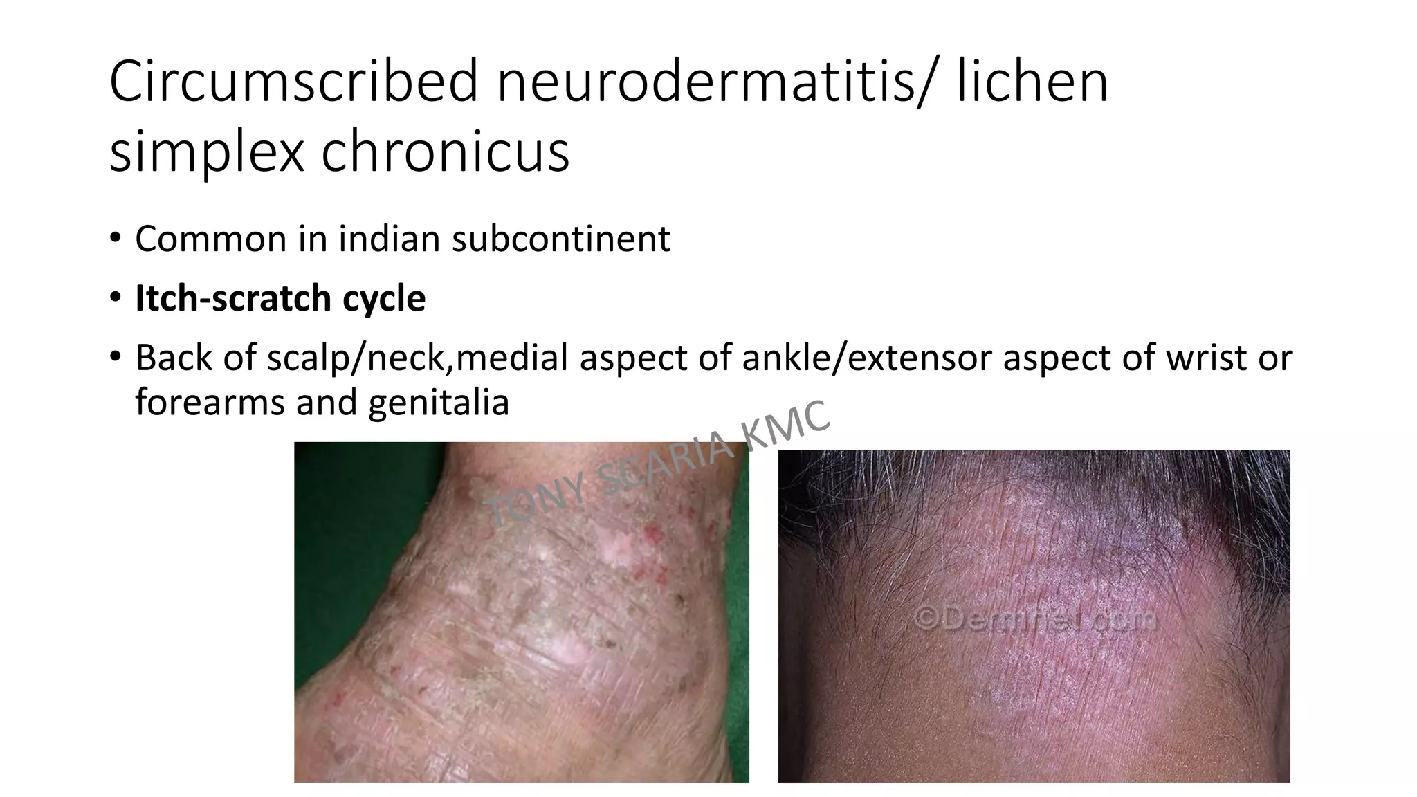 Eczema and dermatitis DERMATOLOGY | PDF