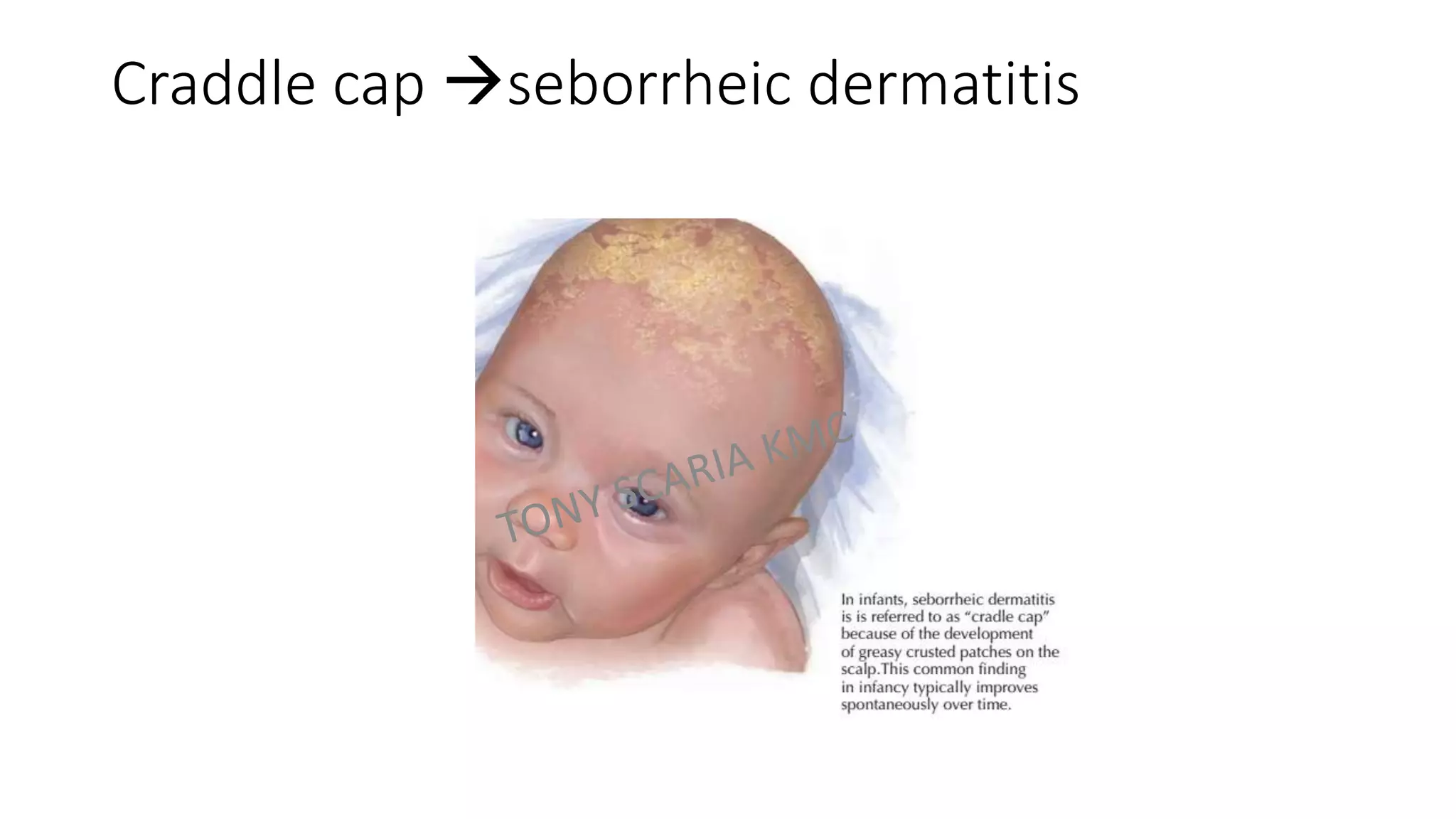 Eczema and dermatitis DERMATOLOGY | PDF