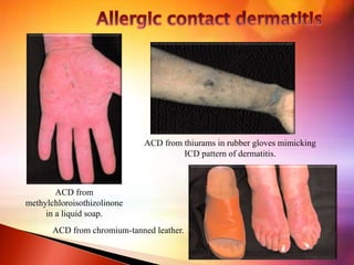 Eczema de contact | PPTX