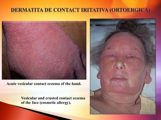 Eczema de contact | PPTX