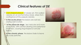 ECZEMA( dermatitis) PART 2.pptx in dermatology | PPTX