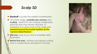 ECZEMA( dermatitis) PART 2.pptx in dermatology | PPTX