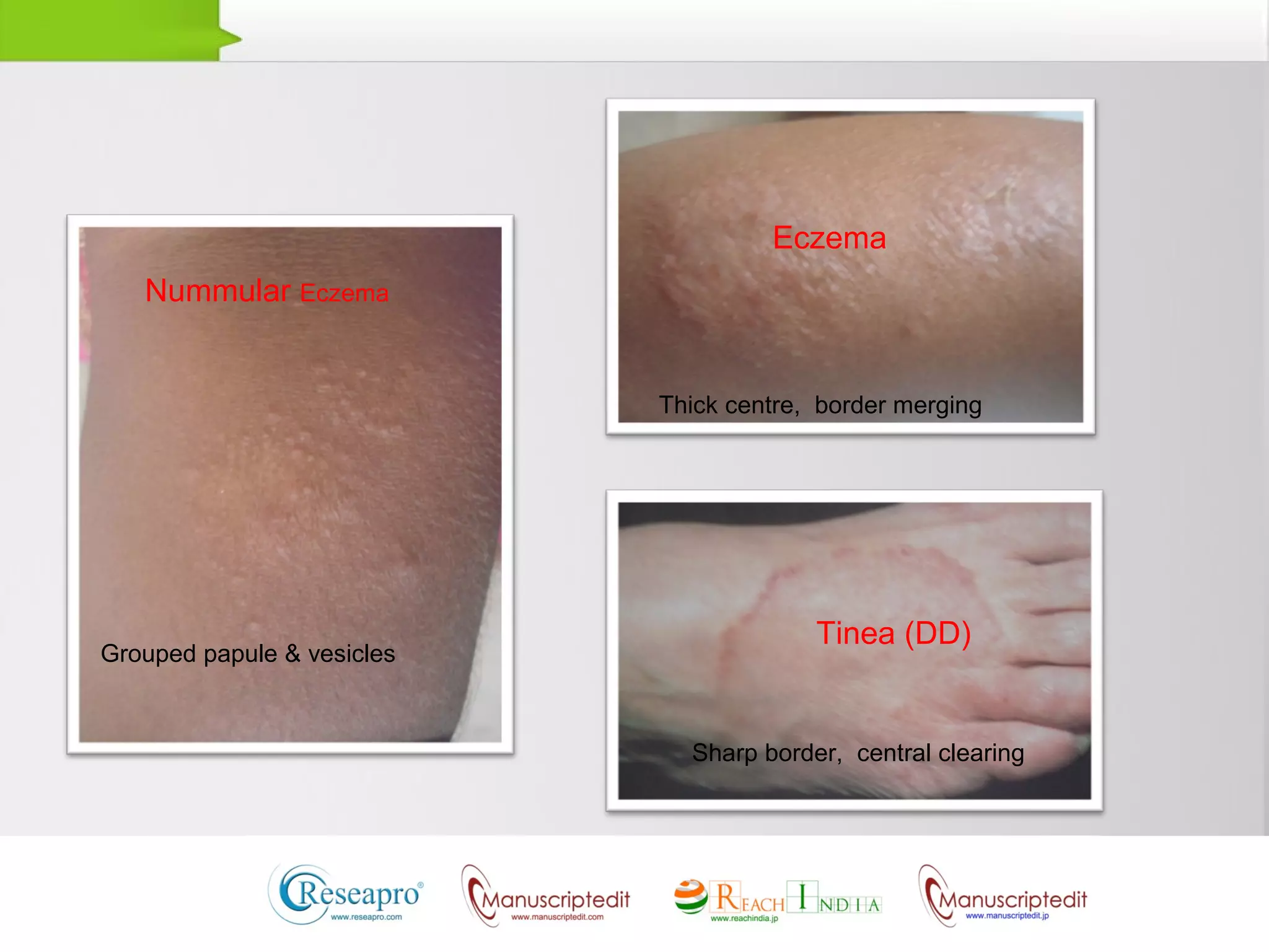 Eczemas : Part - 2 | PPT