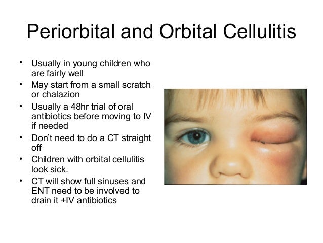 Orbital Cellulitis Vs Periorbital Cellulitis Orbital Cellulitis Vs Periorbital Cellulitis