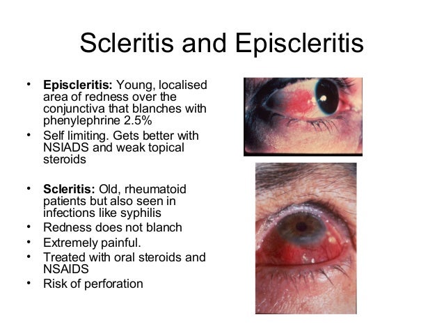 Opthalmology in the ED - Dr Andrew White (June 2013)