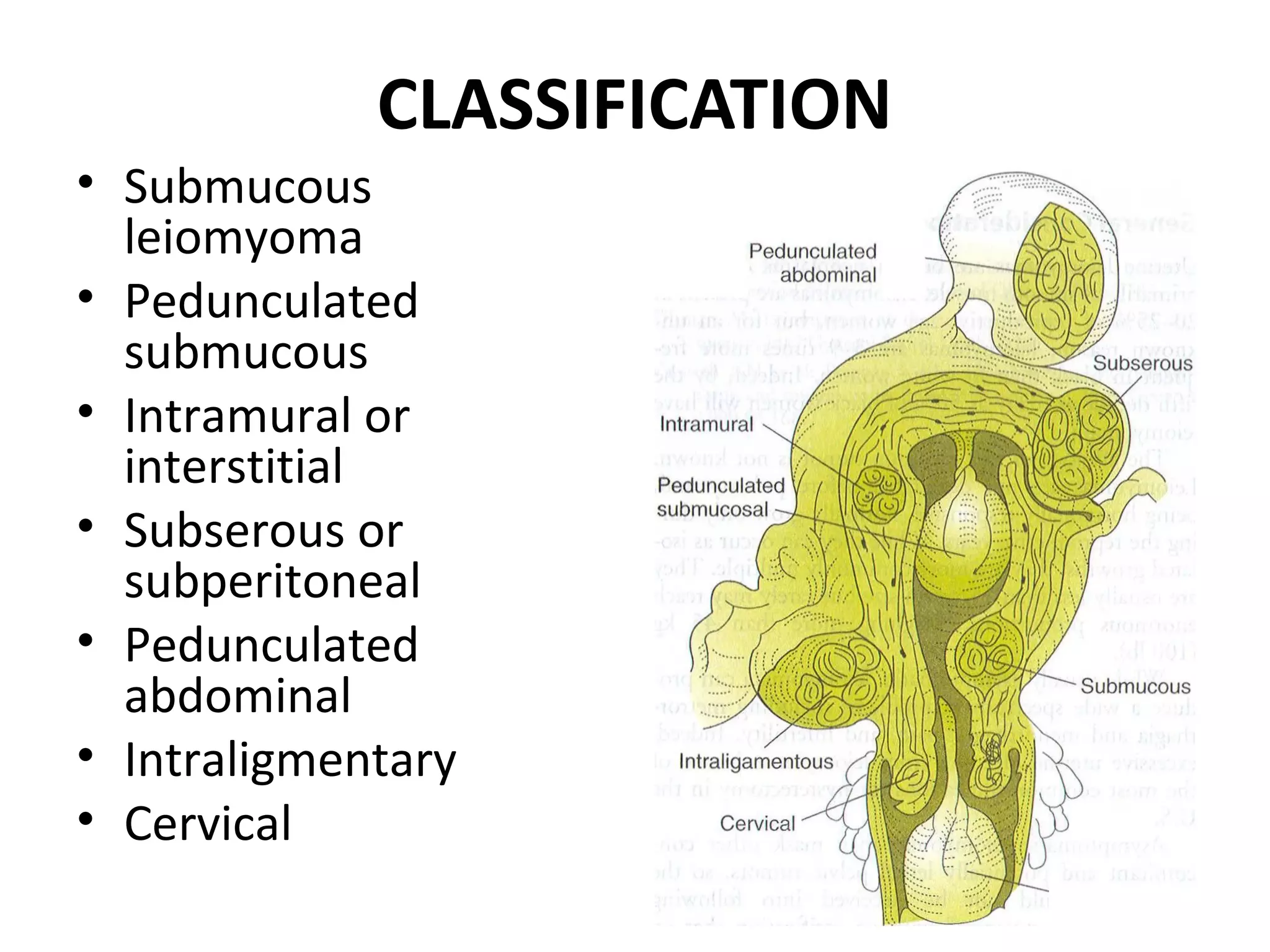 UTERINE FIBROIDS | PPT