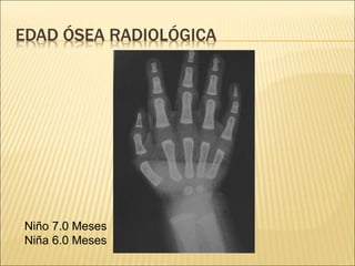 Edad osea | PPT