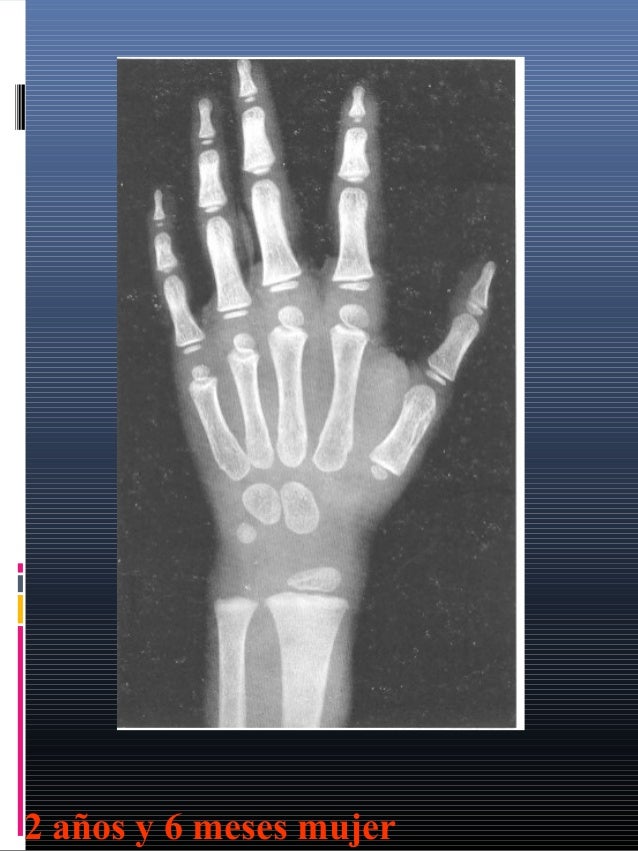 Edad osea de las niñas