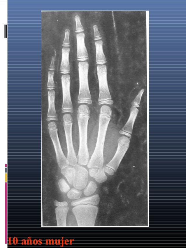 Edad osea de las niñas