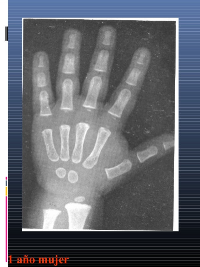 Edad osea de las niñas