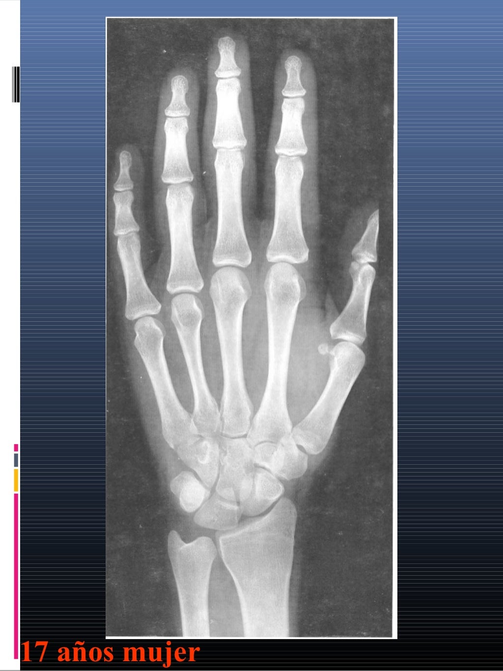 Edad osea de las niñas