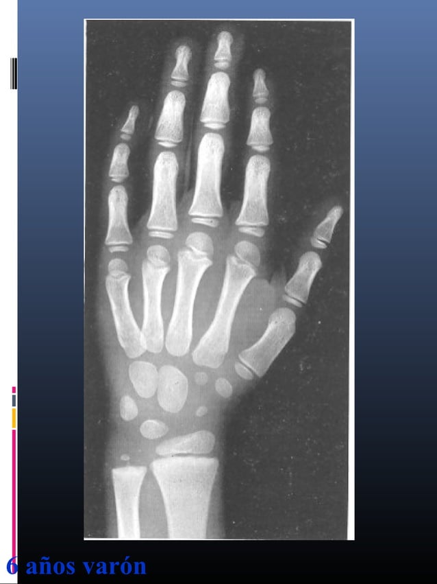 Edad osea en los niños